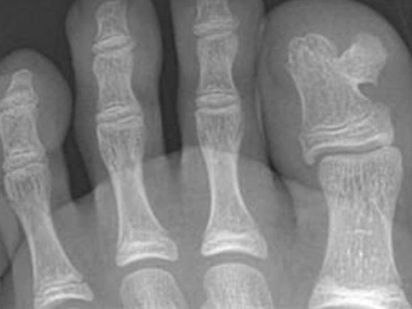 Osteochondroma & Multiple Hereditary Exostosis - Pathology - Orthobullets